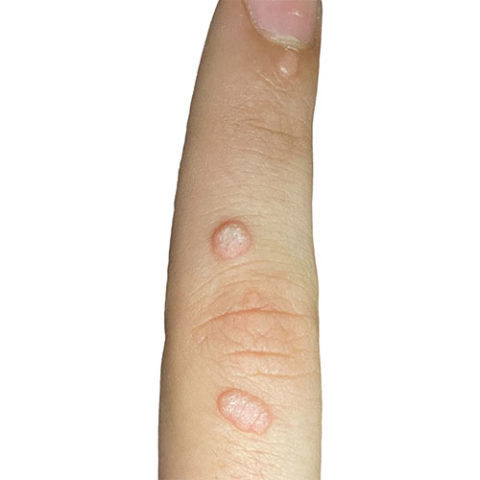 Kryotherapie - Hautarzt Dr. Hannes Trattner