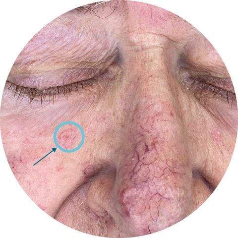 Dermatoskopie - Hautarzt Dr. Hannes Trattner